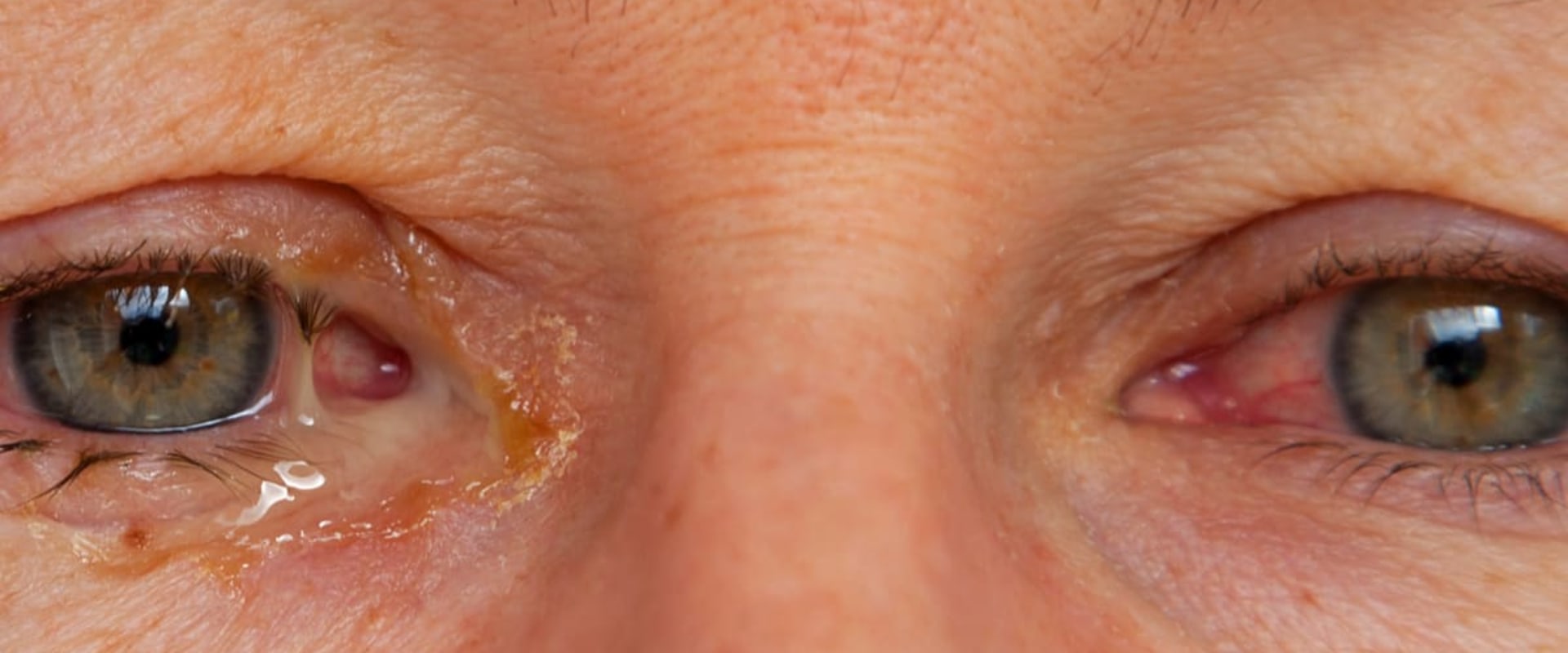 Understanding the Difference Between Mucus and Purulent Discharge: An ...