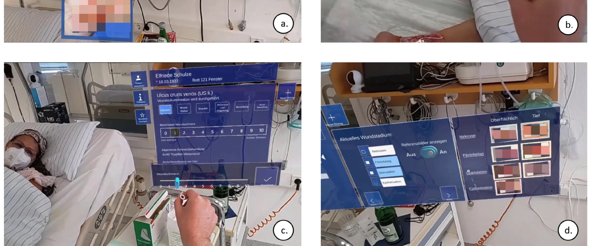 How Granulation Tissue Wound Pictures Show Healing: Visual Insights ...