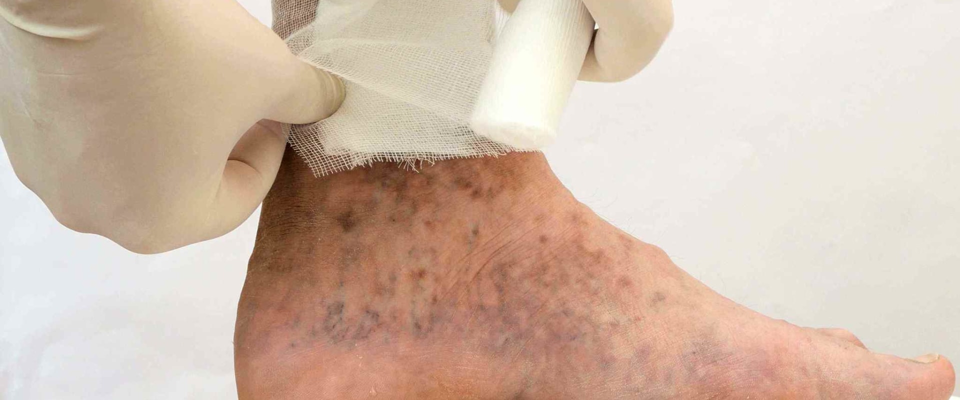 Purulent Drainage: Understanding Its Characteristics and Treatment